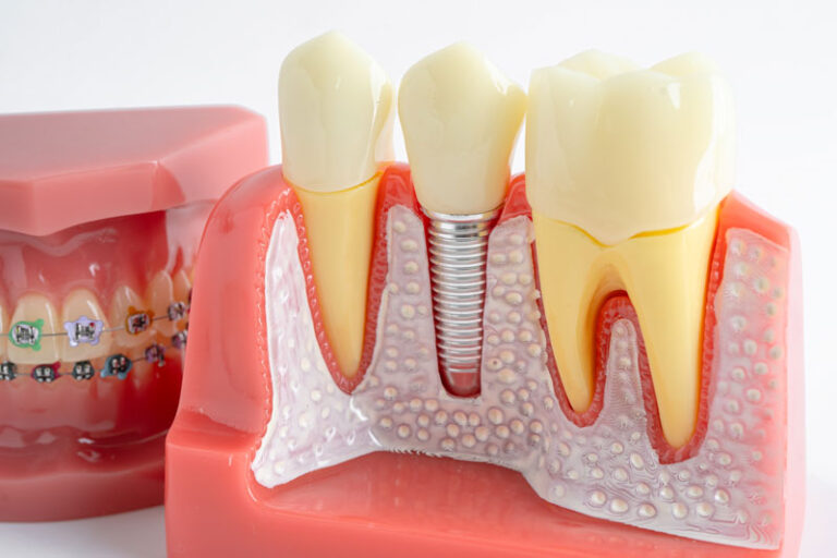 Front Tooth Implant in Chaska, MN | Relaxation Dentistry